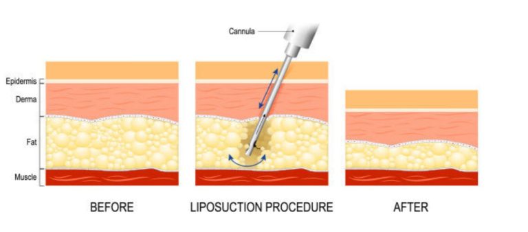 Awake Liposuction Sarasota | Florida Plastic Surgery